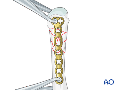 Bridge plating for Extraarticular fracture of the distal end segment