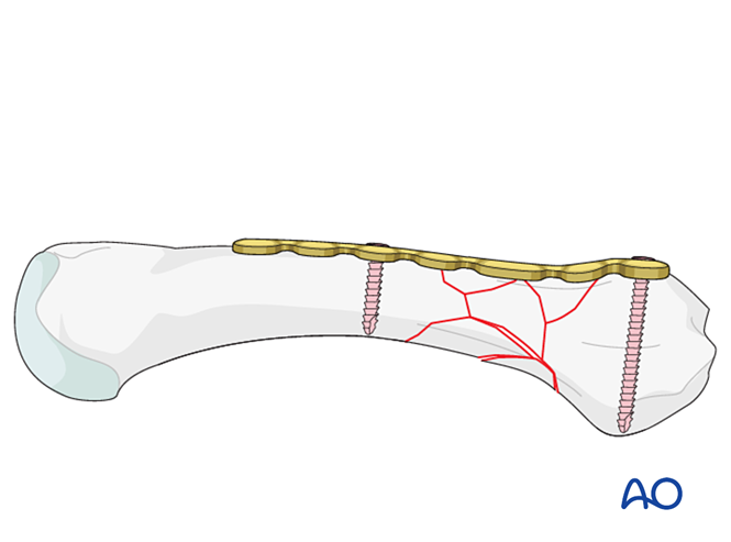 Bridge plating for Extraarticular fracture of the proximal end segment