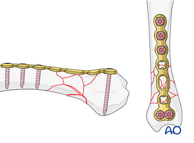 Bridge plating for Extraarticular fracture of the proximal end segment