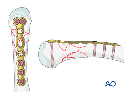 Bridge plating for Extraarticular fracture of the distal end segment