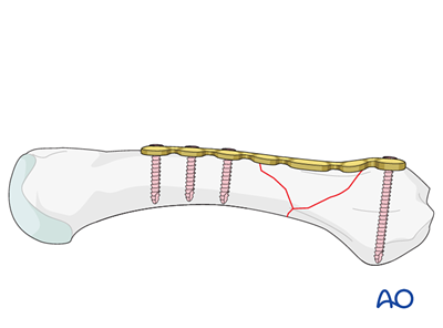 Bridge plating for Extraarticular fracture of the proximal end segment