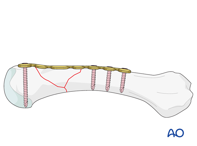 Bridge plating for Extraarticular fracture of the distal end segment