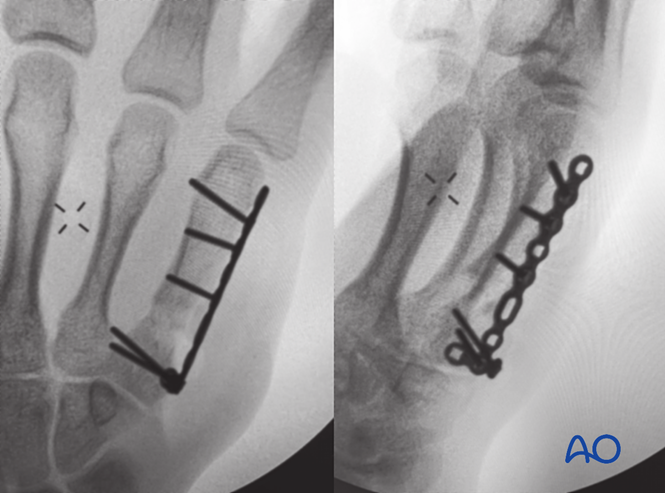 Bridge plating for Extraarticular fracture of the proximal end segment