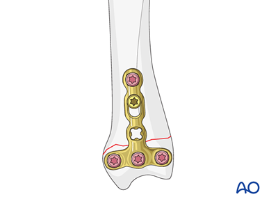 Compression plating for Extraarticular fracture of the proximal end segment