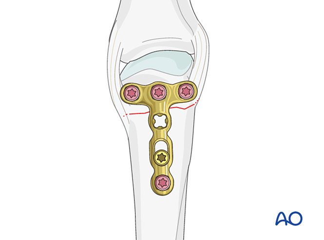 Compression plating for Extraarticular fracture of the distal end segment