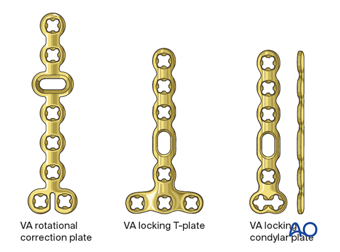 Compression plating for Extraarticular fracture of the proximal end segment
