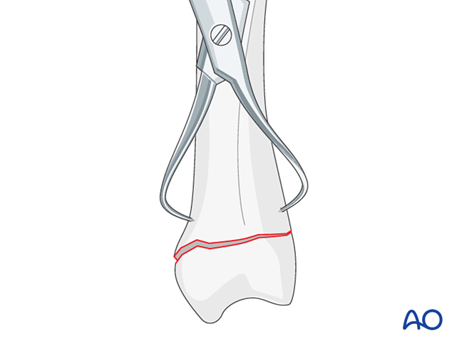 Compression plating for Extraarticular fracture of the proximal end segment