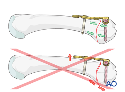 Compression plating for Extraarticular fracture of the proximal end segment
