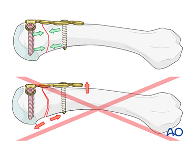 Compression plating for Extraarticular fracture of the distal end segment
