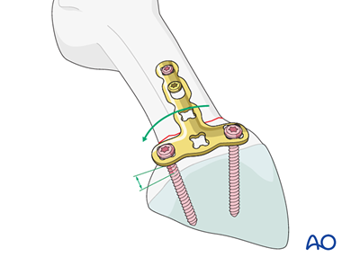 Compression plating for Extraarticular fracture of the proximal end segment