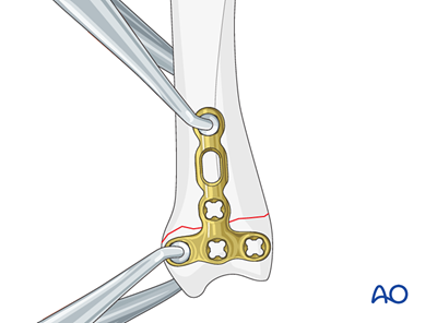 Compression plating for Extraarticular fracture of the proximal end segment