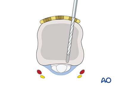 Bridge plating for Extraarticular fracture of the distal end segment