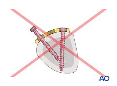 Compression plating for Extraarticular fracture of the proximal end segment