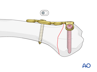 Compression plating for Extraarticular fracture of the proximal end segment