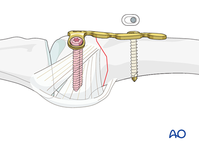 Compression plating for Extraarticular fracture of the distal end segment