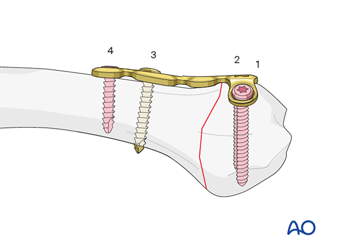 Compression plating for Extraarticular fracture of the proximal end segment