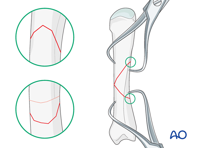Lag-screw and plate fixation for Wedge or multifragmentary fracture of ...