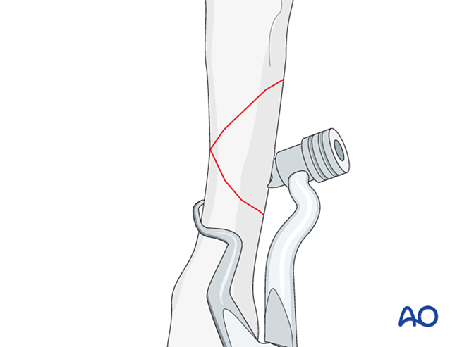 Lag-screw and plate fixation for Wedge or multifragmentary fracture of ...