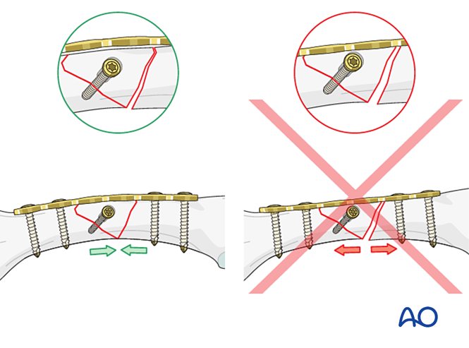 Lag-screw and plate fixation for Wedge or multifragmentary fracture of ...