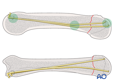 Intramedullary K-wire fixation for Extraarticular fracture of the ...