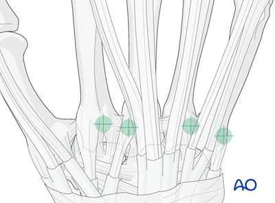Intramedullary K-wire fixation for Extraarticular fracture of the ...