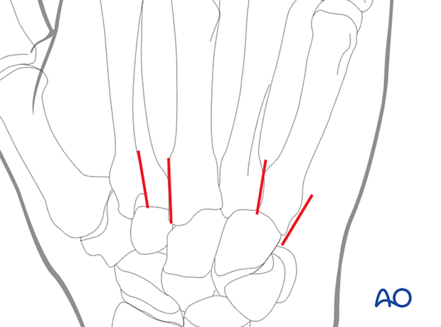 Intramedullary K Wire Fixation For Extraarticular Fracture Of The