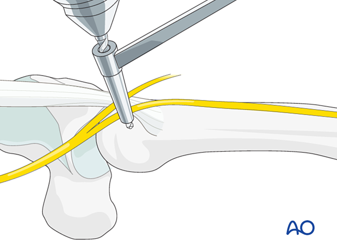 Intramedullary K-wire fixation for Extraarticular fracture of the ...