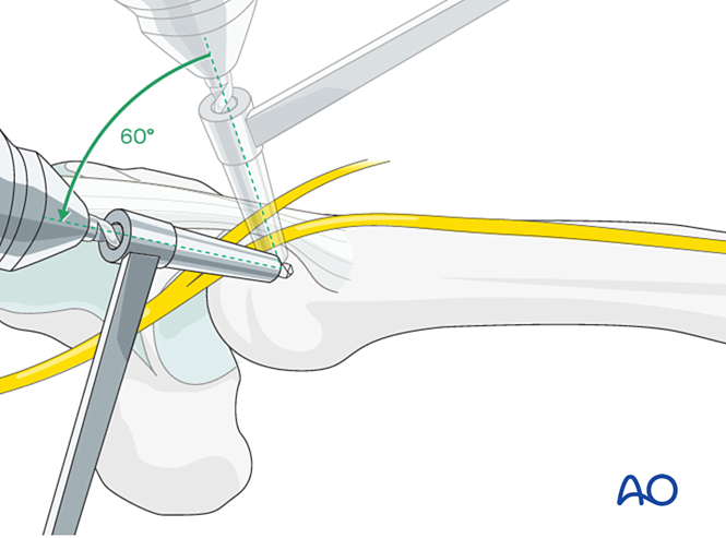 Intramedullary K-wire fixation for Extraarticular fracture of the ...