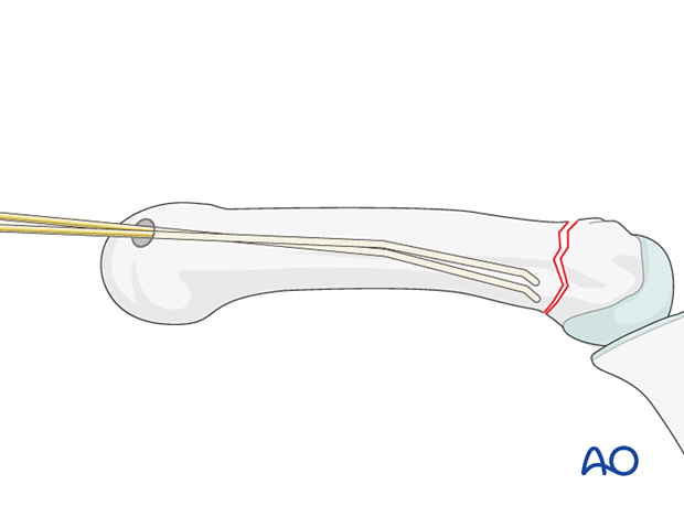 Intramedullary K Wire Fixation For Extraarticular Fracture Of The