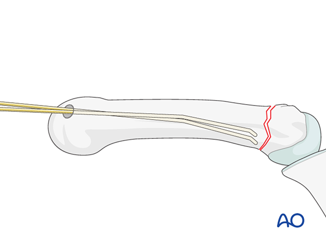 Intramedullary K-wire fixation for Extraarticular fracture of the ...