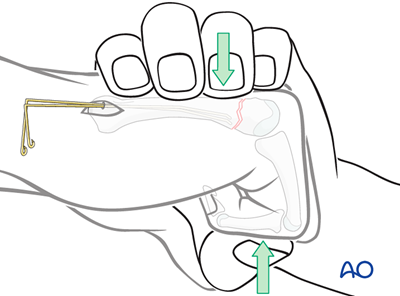 Intramedullary K-wire fixation for Extraarticular fracture of the ...