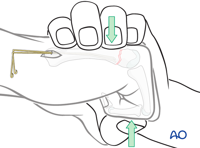 Intramedullary K-wire fixation for Extraarticular fracture of the ...