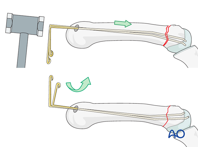 Intramedullary K-wire fixation for Extraarticular fracture of the ...