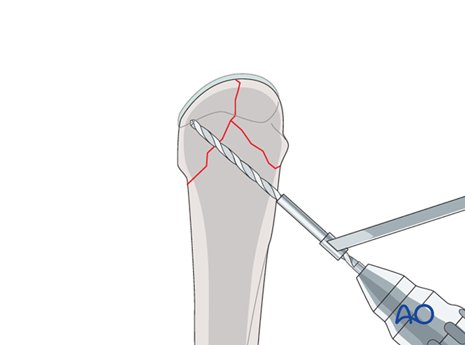 Screw fixation