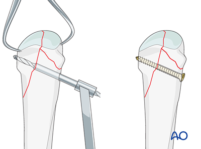 Screw fixation for Articular fracture of the distal end segment
