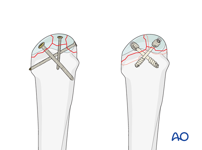Screw fixation