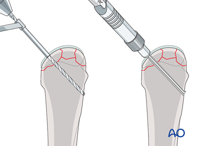 Screw fixation