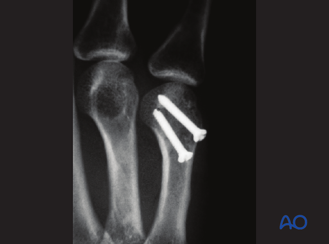 Screw fixation for Articular fracture of the distal end segment
