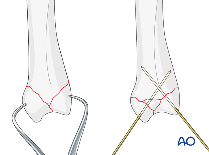 Screw fixation for Complete articular fracture of the proximal end segment