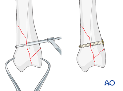 Screw fixation for Complete articular fracture of the proximal end segment