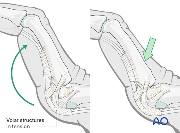 Orif For Dislocation And Fracture Dislocation Of The