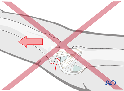 Reduction with or without joint transfixation for Dislocation of the ...