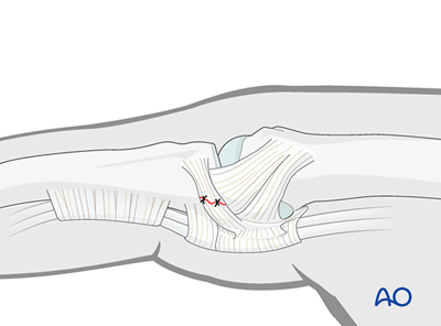 Reduction with or without joint transfixation for Dislocation of the ...