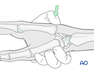 Reduction - Immobilization for Dislocation and fracture-dislocation of ...