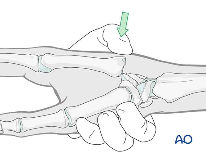 Reduction - Immobilization for Dislocation and fracture-dislocation of ...