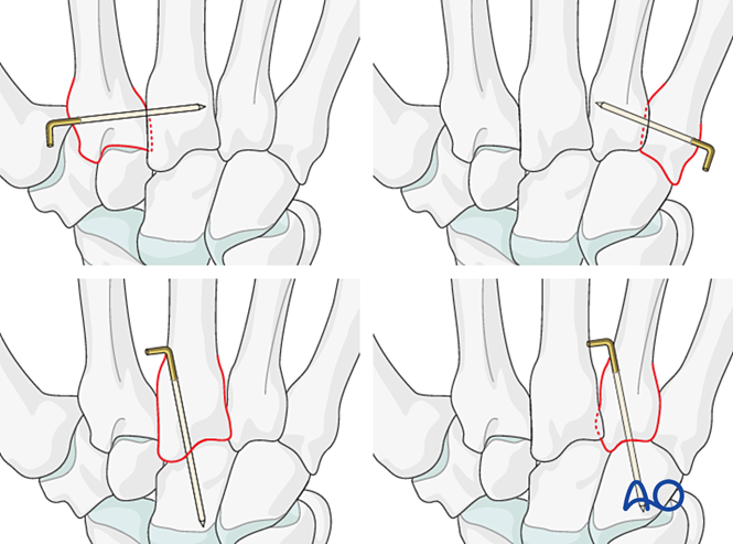 Reduction - Immobilization for Dislocation and fracture-dislocation of ...