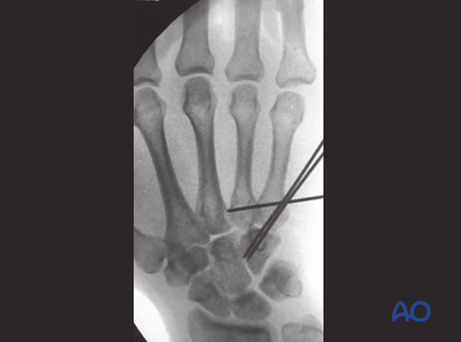Reduction - Immobilization for Dislocation and fracture-dislocation of ...