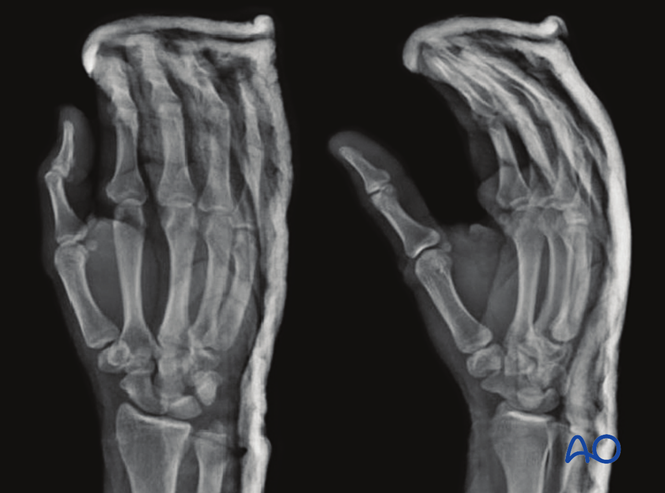 Reduction - Immobilization for Dislocation and fracture-dislocation of ...