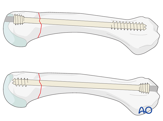 Intramedullary screw fixation for Extraarticular fracture of the distal ...