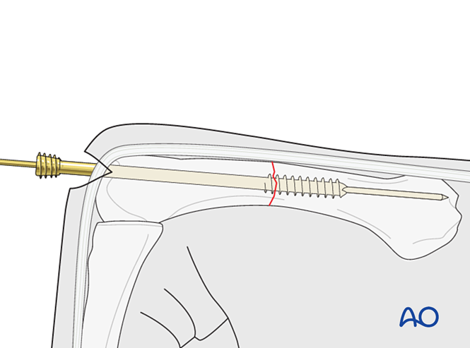 Intramedullary screw fixation for Simple transverse fracture of the ...